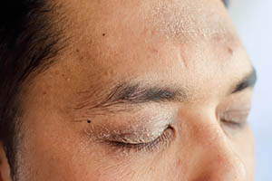 Face the Facts: All About Facial Eczema | National Eczema Association