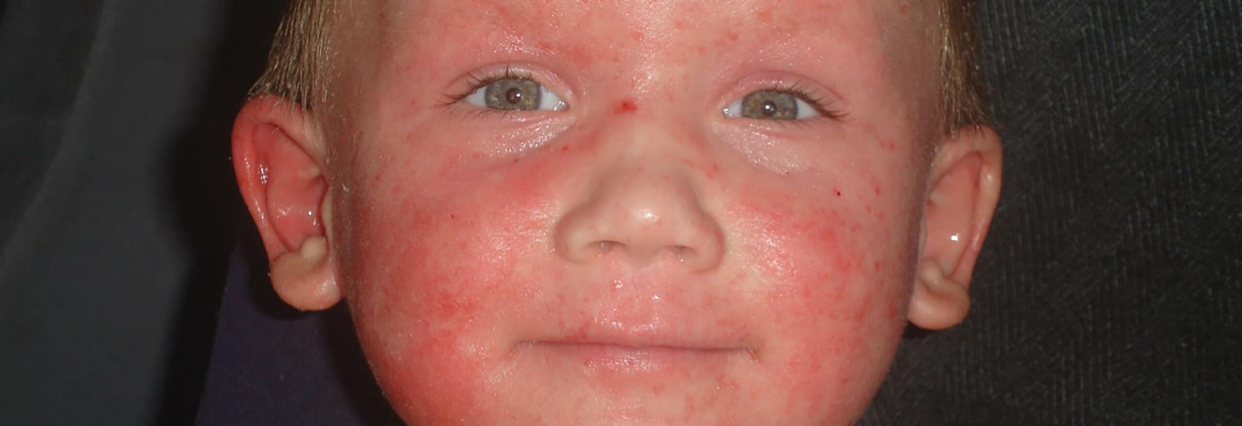 Topical Steroid Withdrawal and Eczema | Steroid Risks | National Eczema ...