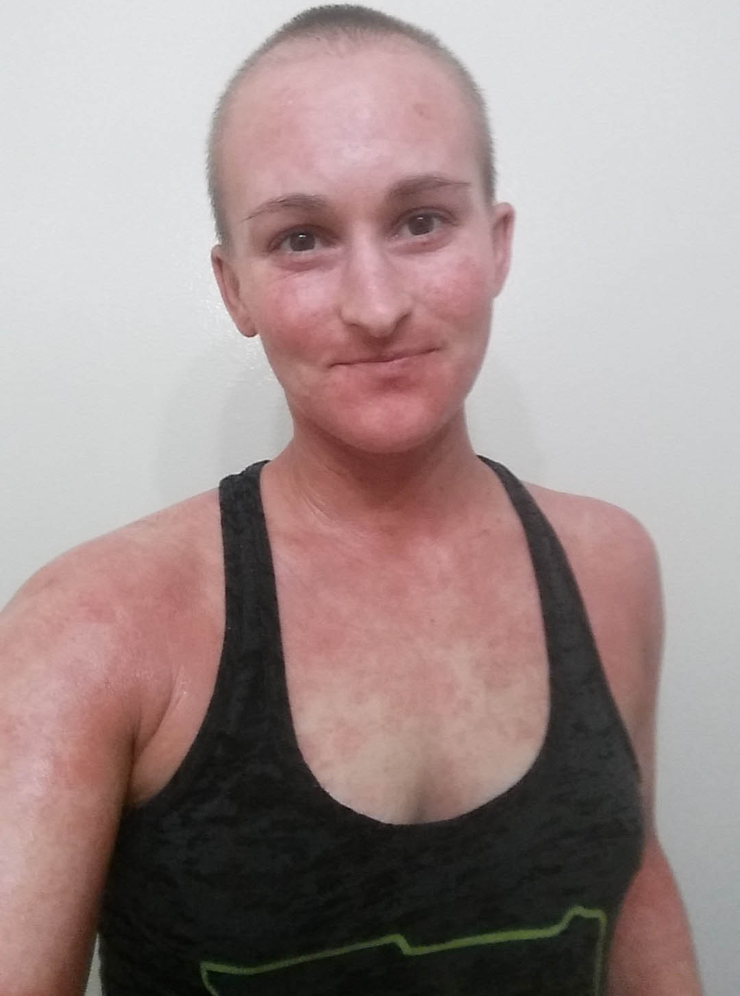 Topical steroid withdrawal: Everything you need to know