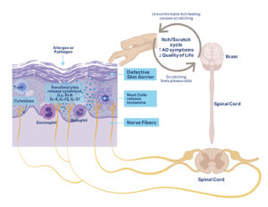 The Complex Science Behind Itch in Atopic Dermatitis | National Eczema ...