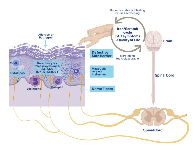 The Complex Science Behind Itch in Atopic Dermatitis | National Eczema ...