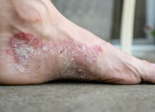 Eczema and Aging | National Eczema Association