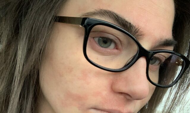 NEA Ambassadors Archives | National Eczema Association