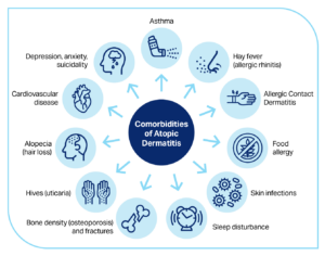 The Atopic March and Beyond – Other Health Issues Connected with Atopic ...
