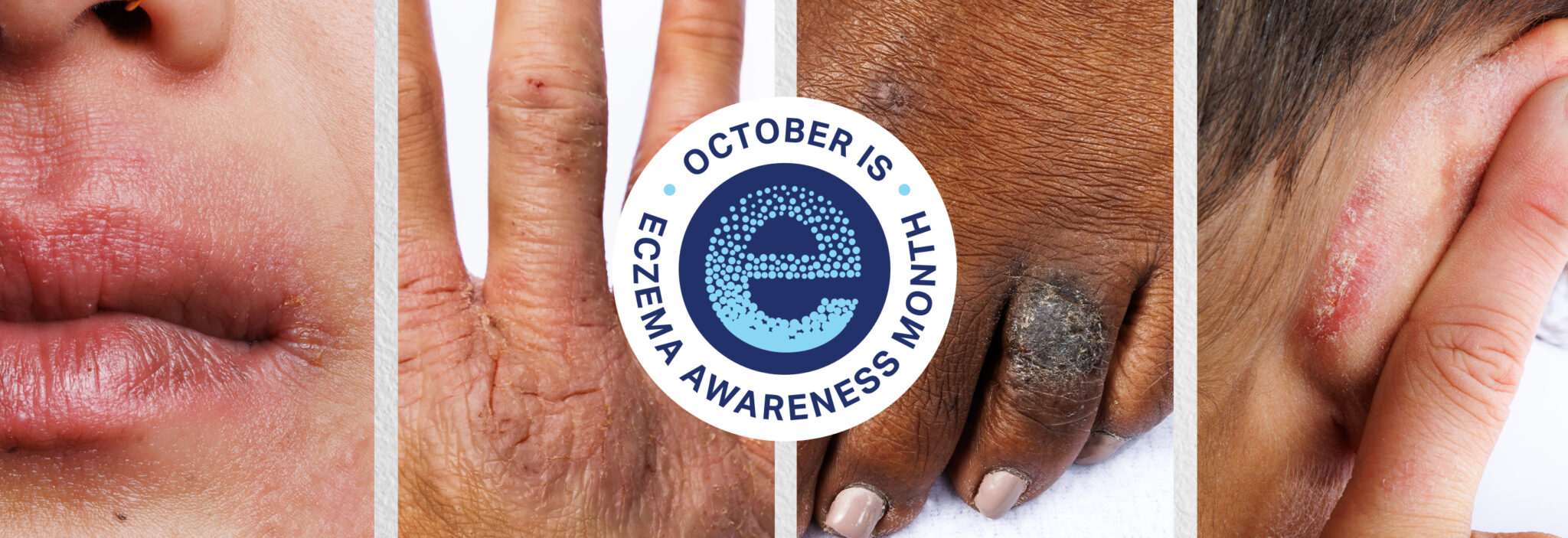 Eczema Awareness Month | National Eczema Association