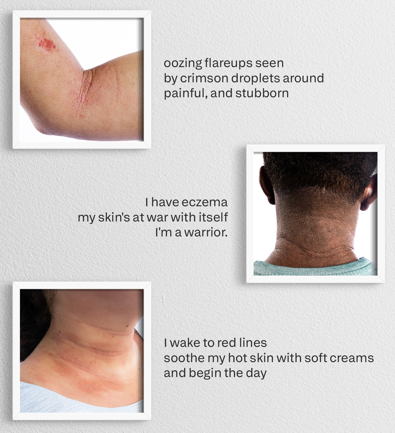 Eczema Awareness Month 2024: The Ecz-hibition | National Eczema Association