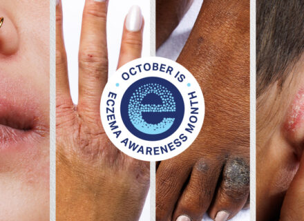 Eczema and Aging | National Eczema Association